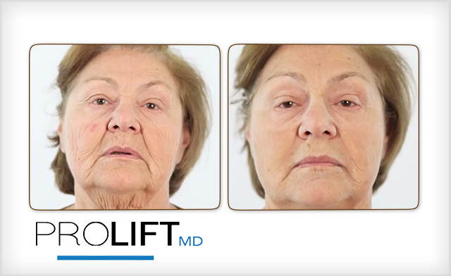 $39 for a PROLIFT MD - Instant Facelife Serum - 30 Individual Sachets ...
